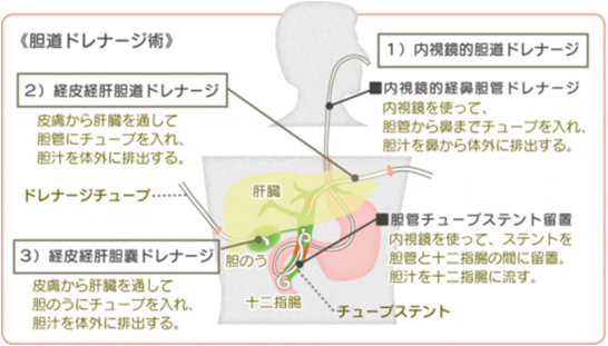 ptgbdチューブ 在宅, ptcd 在宅管理パンフレット – MEPQLG