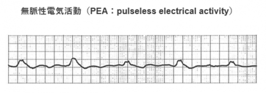 VFを起こした患者の看護に、何が必要基本の急変対応と「5H5T」を覚えよう！ | ナースのヒント