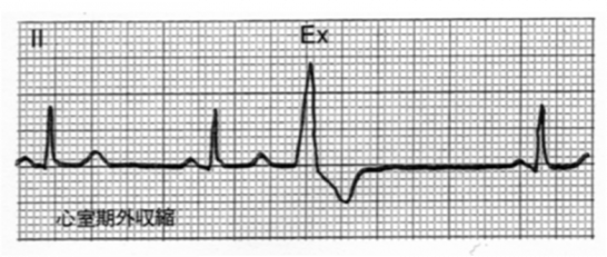 PVC（VPC）が出た時の対応は？焦らず5つのポイントを確認し、もしもに備えよう | ナースのヒント