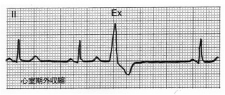 PVC（VPC）が出た時の対応は？焦らず5つのポイントを確認し、もしもに備えよう | ナースのヒント