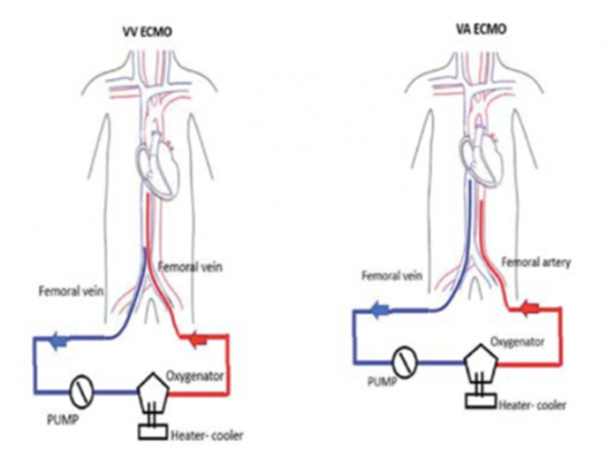ECMOにおける看護｜2つのECMOと看護のポイント | ナースのヒント